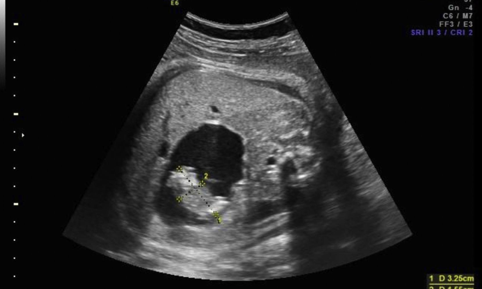 Doctors successfully remove parasitic twin fetus from newborn