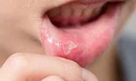 Persistent lumps, ulcers, and unusual bleeding: the hidden signals of ...